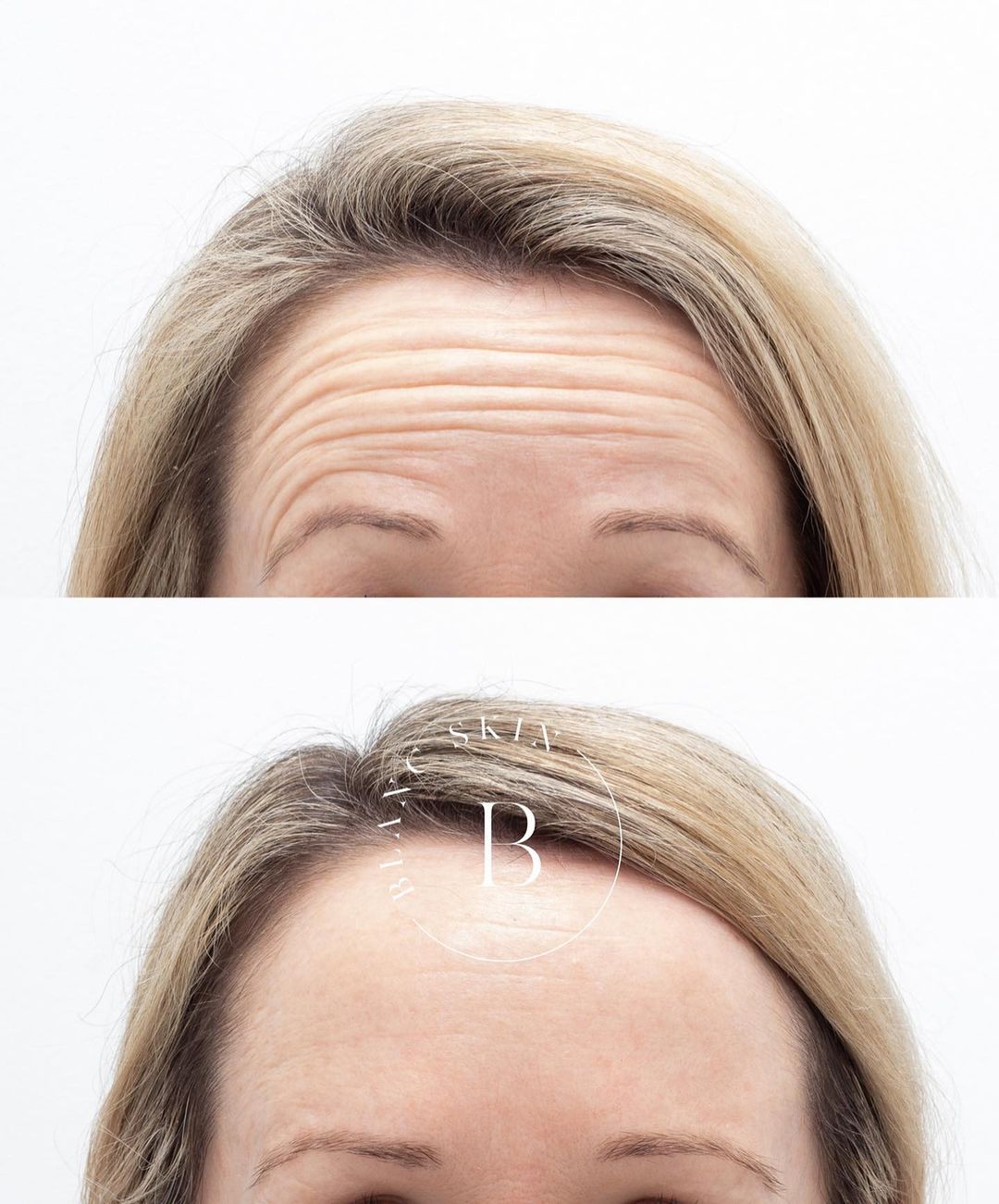 Anti-Wrinkle Injections Perth - Muscle Relaxers | BLANC